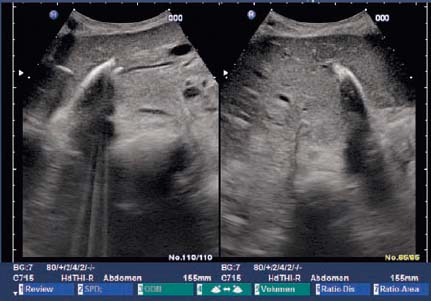 EUS-Guided Biliary Drainage | Radiology Key