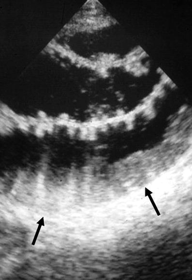 Intestinal Obstruction | Radiology Key