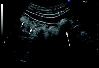 Bowel Ultrasound: Investigation Technique and Normal Findings ...