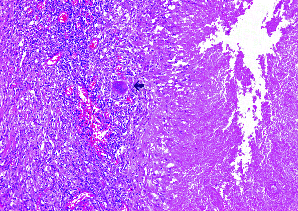 Inflammatory Conditions of the Kidney | Radiology Key