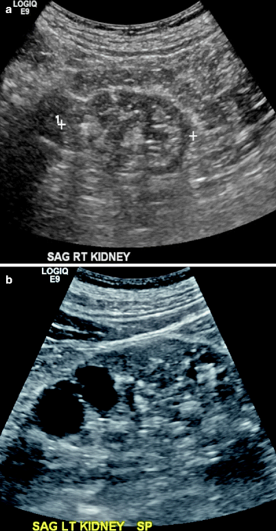 Renal Calculus Disease | Radiology Key