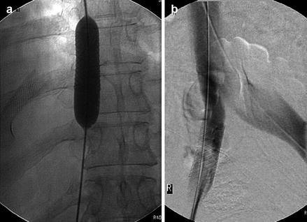 Migrated Stent Graft During TIPS Revision | Radiology Key