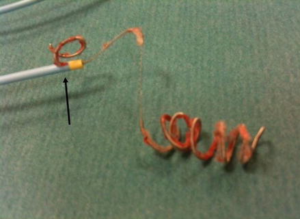 Embolization Coil Trapped in the Side Hole of a Catheter | Radiology Key
