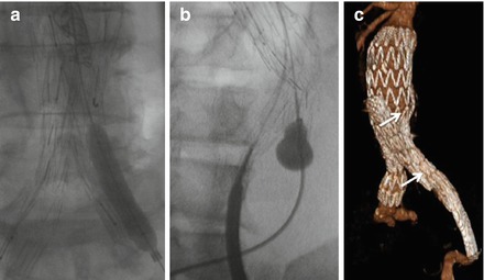 Maldeployment of the Contralateral Limb During EVAR | Radiology Key