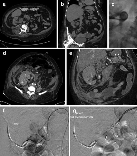 Hemorrhage Following Percutaneous Nephrostomy | Radiology Key