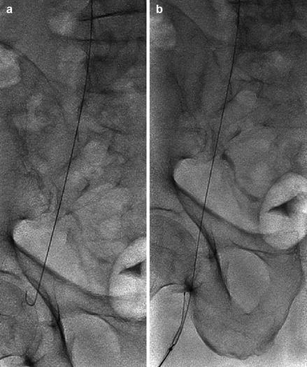 Retrieval of an Intravascular Foreign Body in the Venous System ...