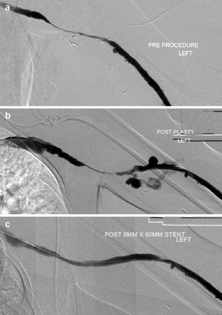Fistula Rupture Post-fistuloplasty | Radiology Key