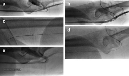 Circumferential Balloon Rupture and Retained Fragments During ...