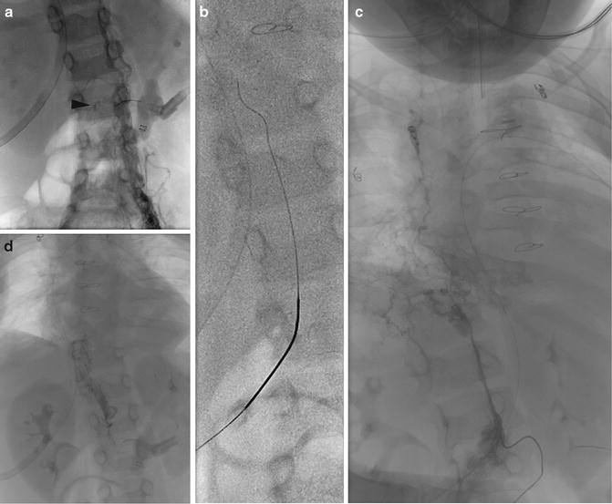 Vascular Interventions: Lymphangiography and Thoracic Duct Embolization ...