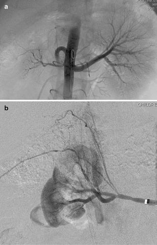 Hemodialysis Graft and Fistula Access and Intervention | Radiology Key