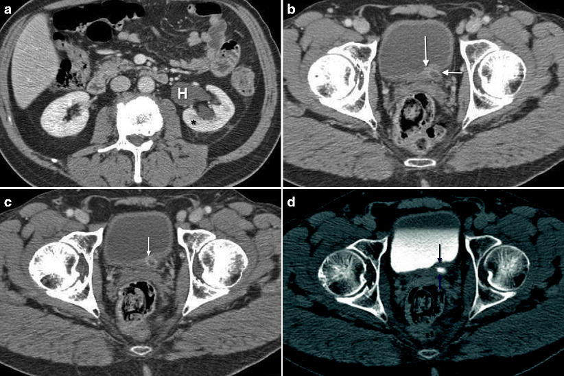 Upper Tract Oncologic Imaging | Radiology Key