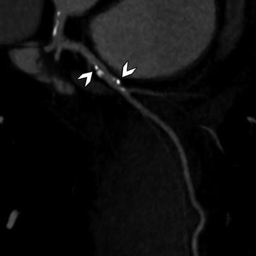Coronary Artery Stents | Radiology Key