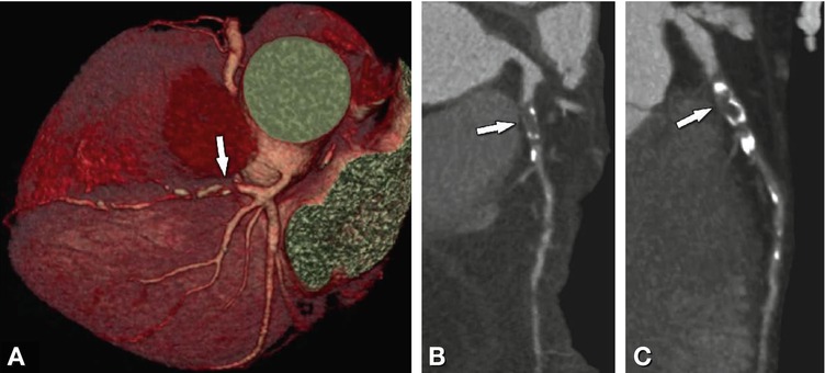 Cardiac CT in Clinical Practice | Radiology Key