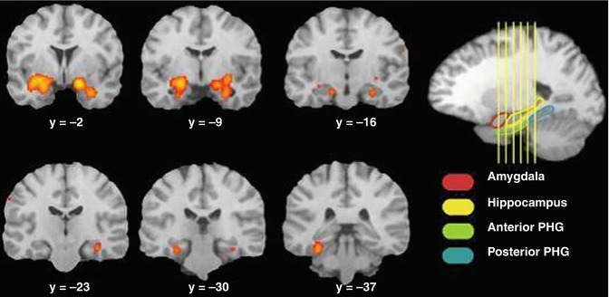 Emotions | Radiology Key
