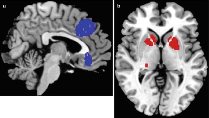 Functional Neuroimaging of Anxiety Disorders | Radiology Key