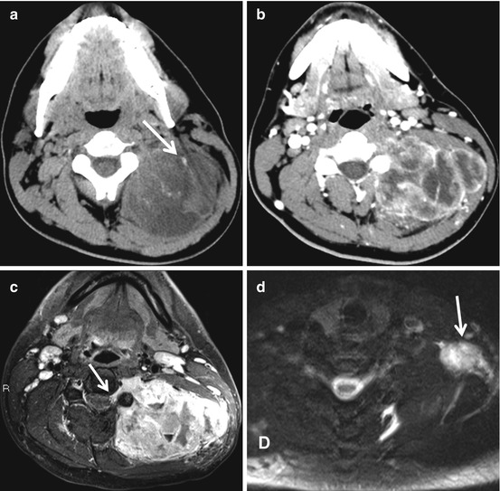 Spaces of the Neck | Radiology Key