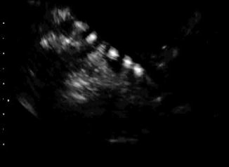 Evaluation of Tubal Patency (HyCoSy, Doppler) | Radiology Key