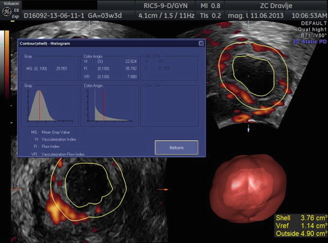 The Normal Ovary (Changes in the Menstrual Cycle) | Radiology Key