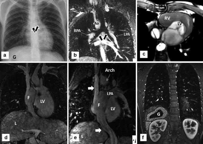 Visceroatrial Situs in Congenital Heart Disease | Radiology Key