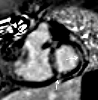 Cardiac CT and MR Evaluation of the Adult Fontan Patient | Radiology Key