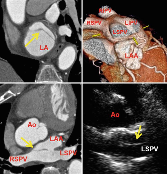 Visceroatrial Situs in Congenital Heart Disease | Radiology Key