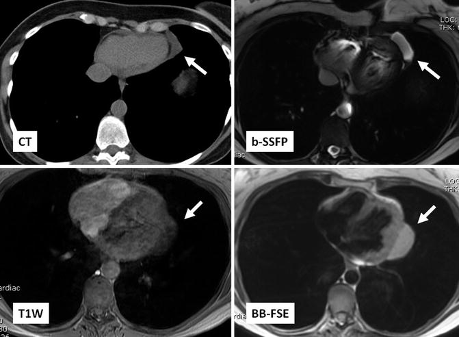 Congenital Pericardial Anomalies | Radiology Key