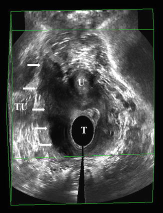 Space Of Retzius Ultrasound