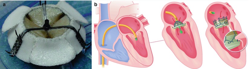 Percutaneous Management of Mitral Regurgitation | Radiology Key