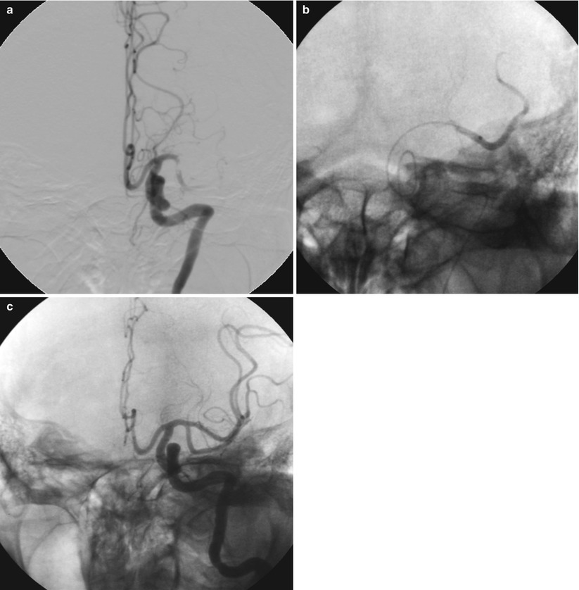 Acute Stroke Intervention Radiology Key