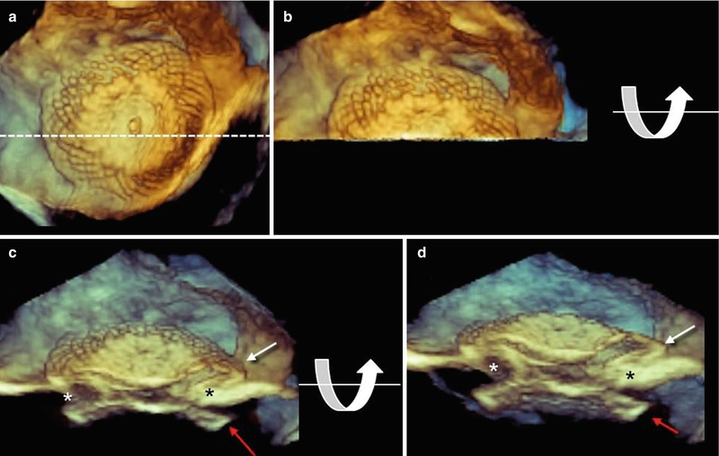 Closure of Patent Foramen Ovalis and Atrial Septal Defect | Radiology Key
