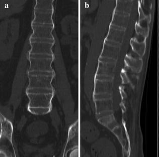 Musculoskeletal Manifestations of Ulcerative Colitis | Radiology Key