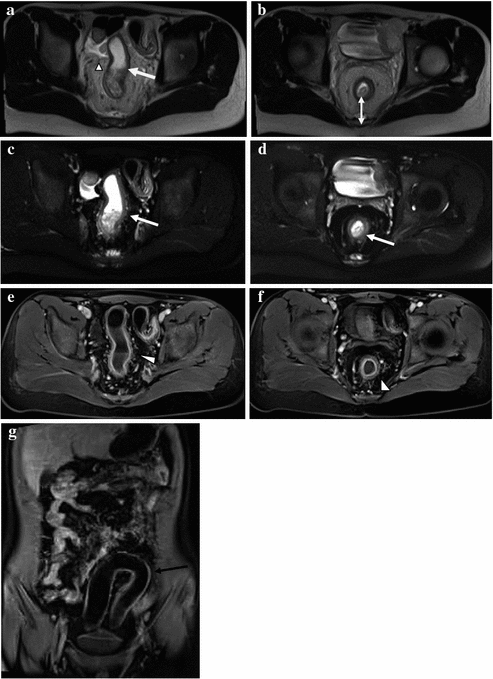 Magnetic Resonance Imaging of Ulcerative Colitis | Radiology Key