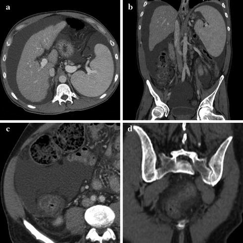 Cross-Sectional Imaging Mimics of Ulcerative Colitis | Radiology Key