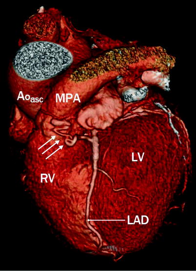 Damus–Kaye–Stansel Procedure | Radiology Key
