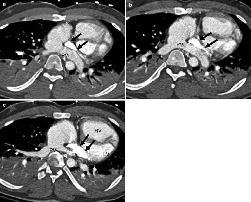Atrial Baffles for the Treatment of Transposition of the Great Arteries ...