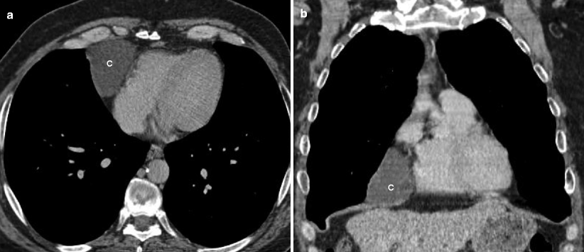 Congenital Absence of the Pericardium | Radiology Key