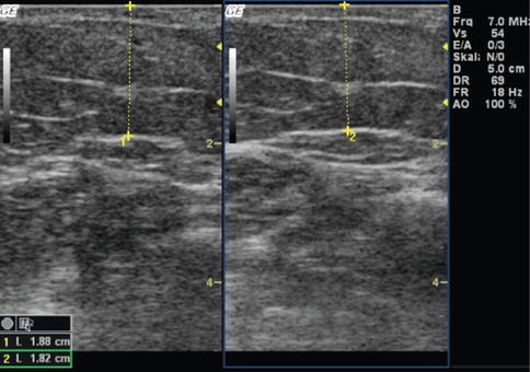 Differential Diagnosis of Leg Oedemas of Venous and Lymphatic Origin ...