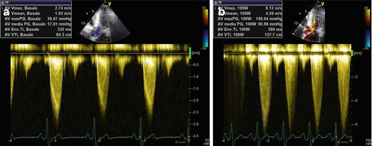 Basic Echocardiography in Hypertrophic Cardiomyopathy | Radiology Key