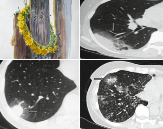 or Reversed Halo Sign | Radiology Key