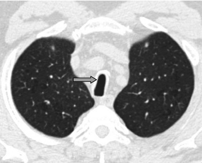 Trachea | Radiology Key