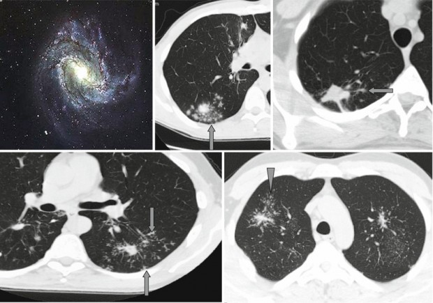 Lung | Radiology Key