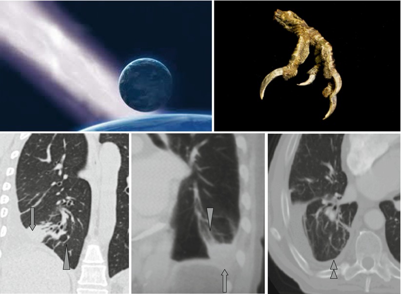 Atelectasis, Comet-Tail Sign, and Crow’s Foot Sign | Radiology Key