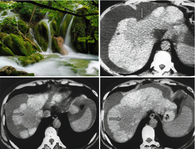 Liver Sign | Radiology Key