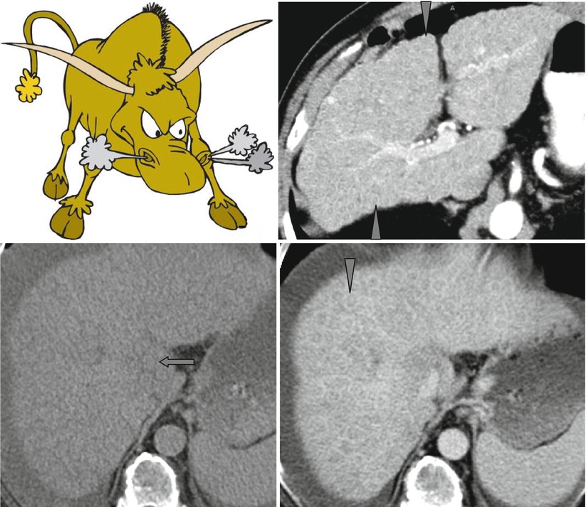 Liver Radiology Key