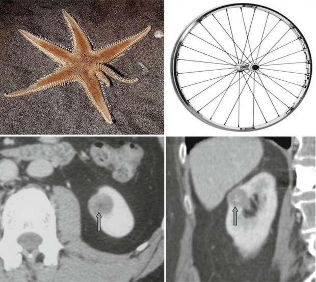 Sign and Cannonball Metastases | Radiology Key