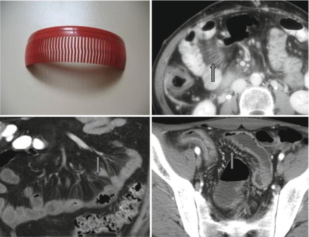 Halo Sign | Radiology Key