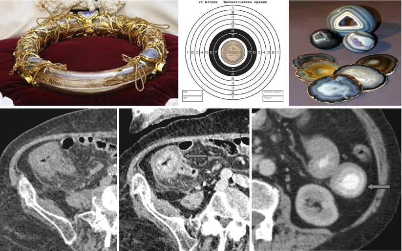 Attenuation, Double Halo Sign, and Target Sign | Radiology Key