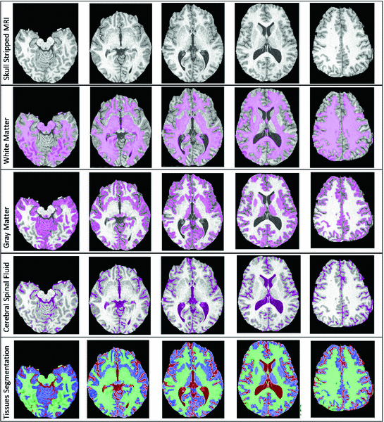 of the Prognostic Relevance of Longitudinal Brain Atrophy in Post ...