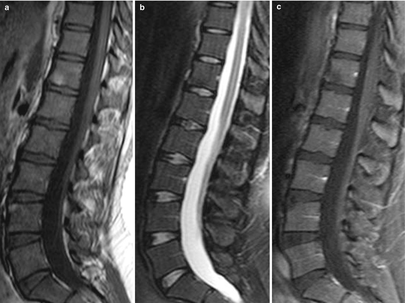 Psoriatic Arthritis | Radiology Key