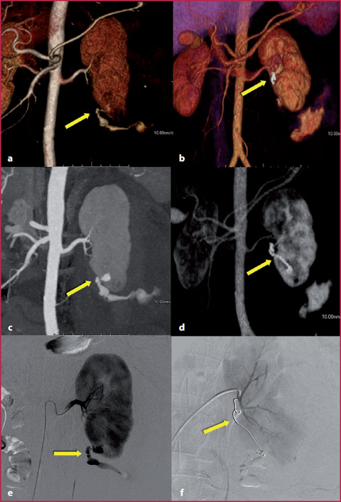 Renal Arteries and Splanchnic Vessels | Radiology Key